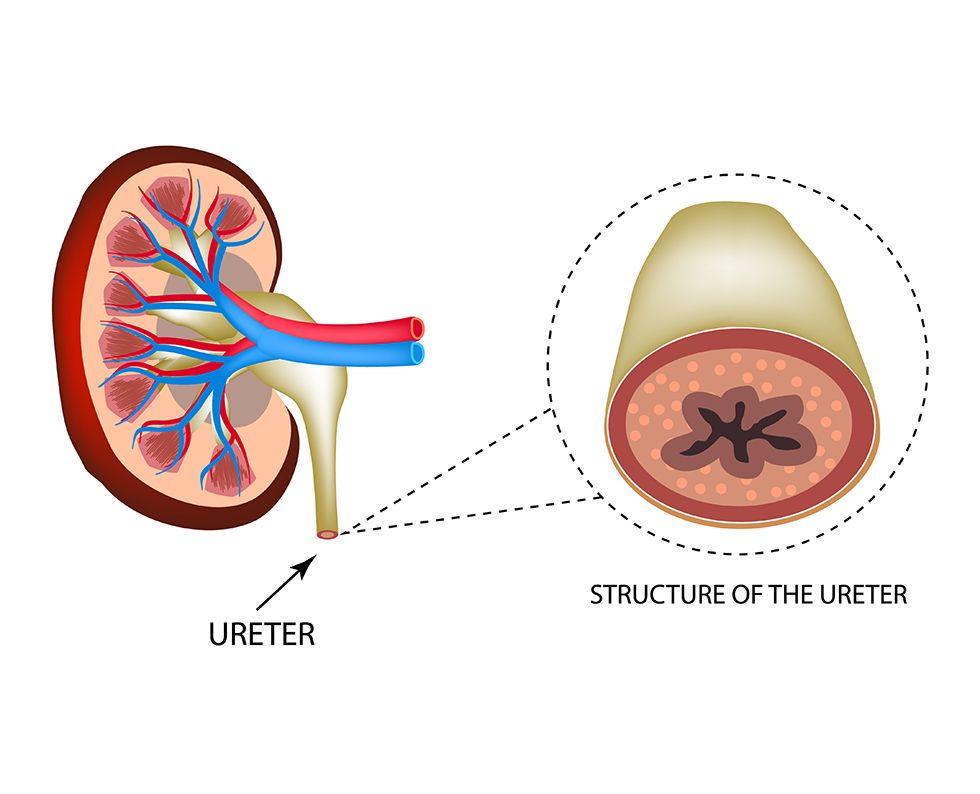 Upper Tract Urothelial Carcinoma (UTUC) - Urology Clinic P.C.
